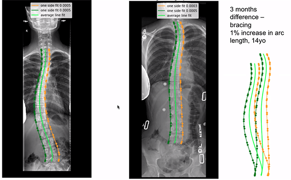Using 20,000 Spinal Radiographs to Create Global Curvature and ...